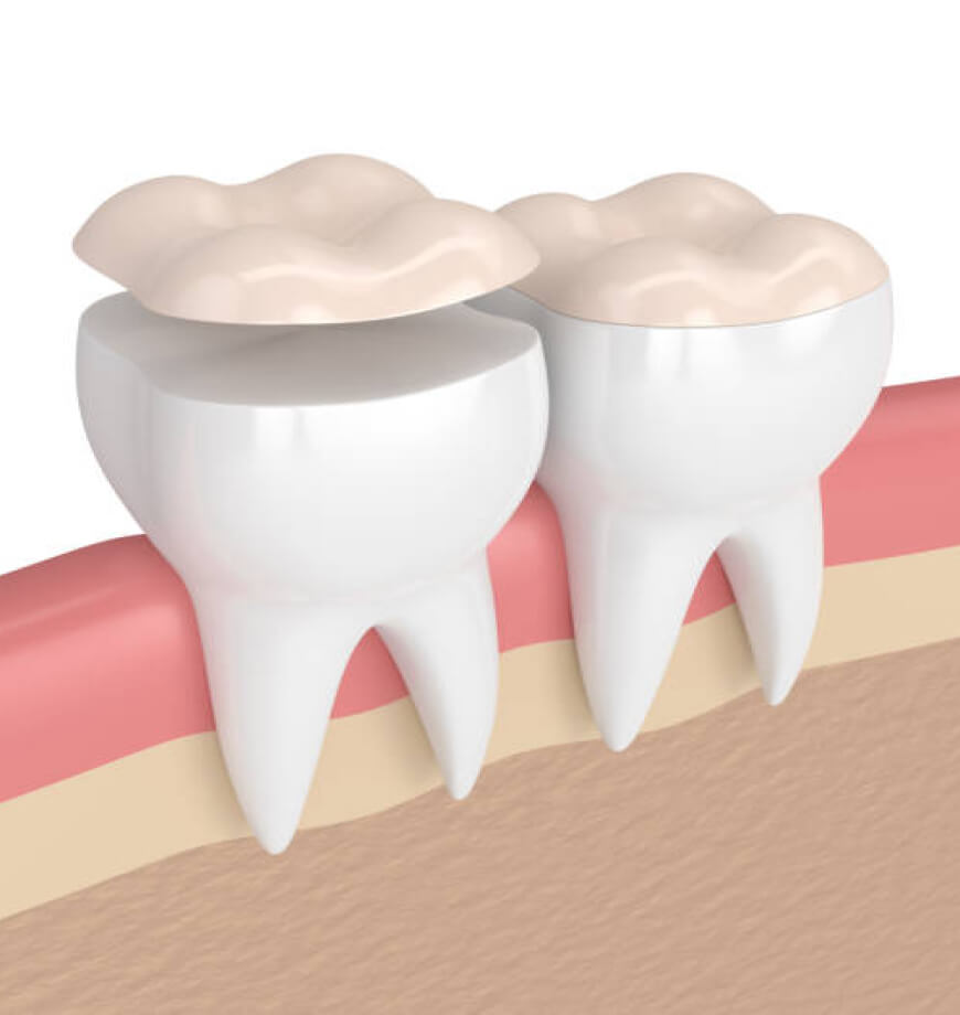 Dental Inlays and Onlays Nassau Bay TX | NassauBay Dental
